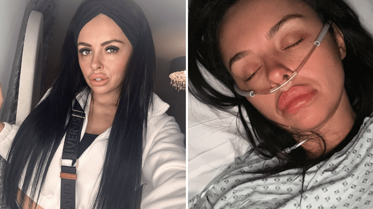 Woman feared amputation after liquid BBL treatment left her ‘fighting ...