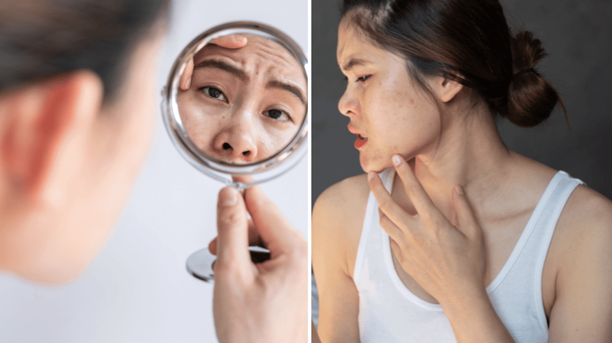 What ‘cortisol face’ really is as doctor warns to seek advice on symptoms