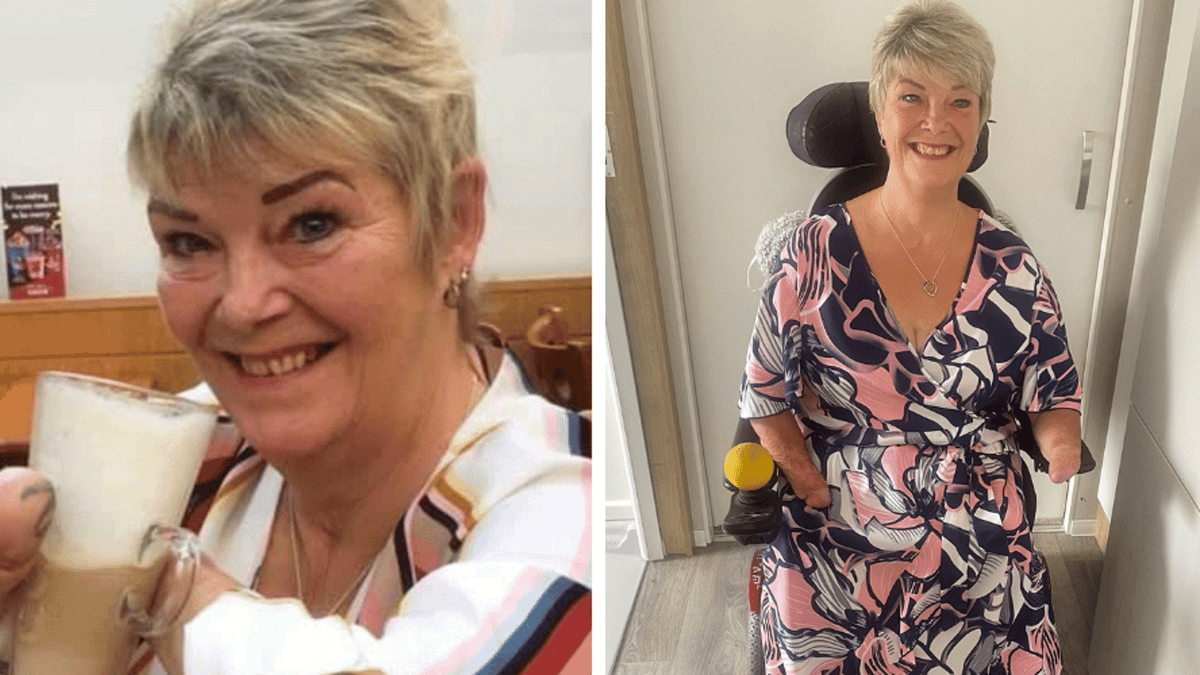 Woman forced to have hands and legs amputated after getting sepsis on ...
