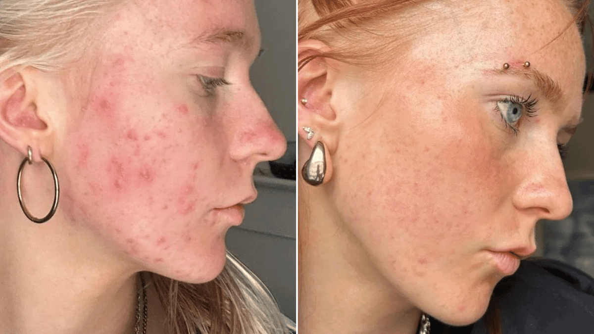 Women say 'game-changing' face mask with surprising ingredient combats ...