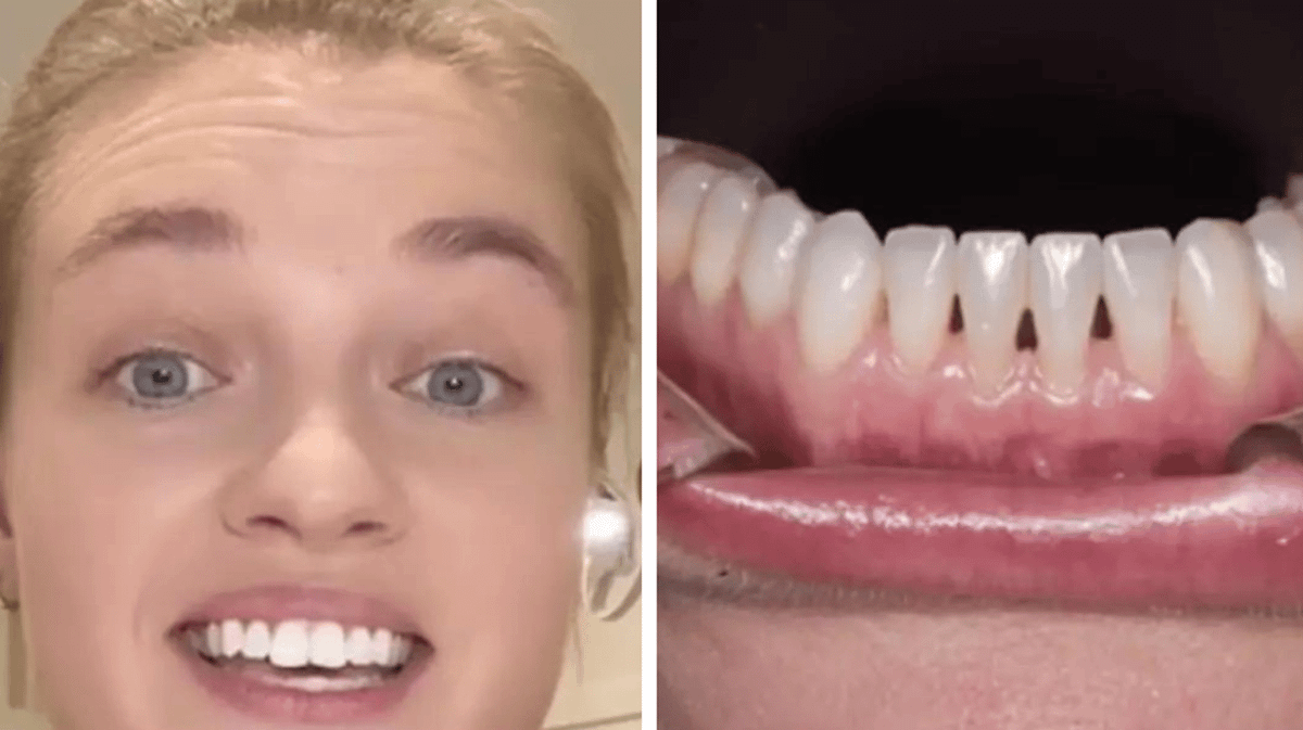 What does it mean if you have black triangles between your teeth?