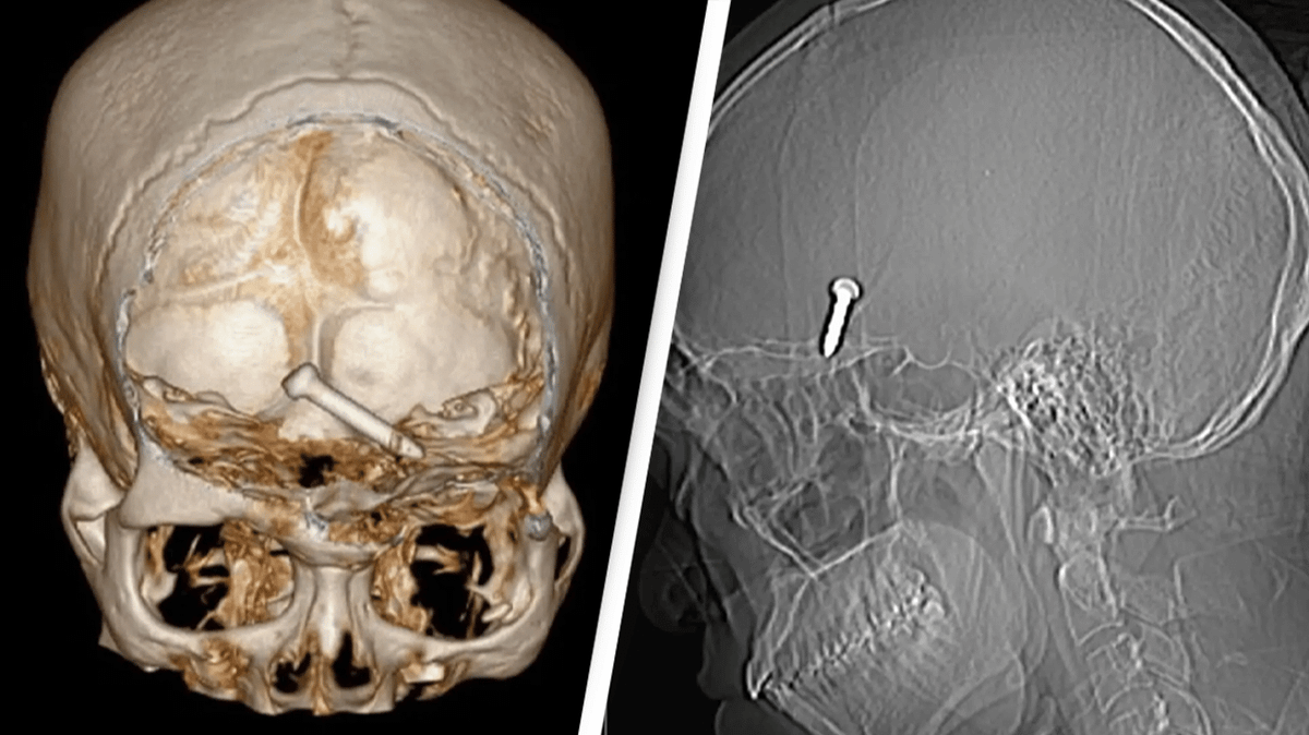 Surgeons remove 3cm nail lodged in man’s brain after accidentally ...