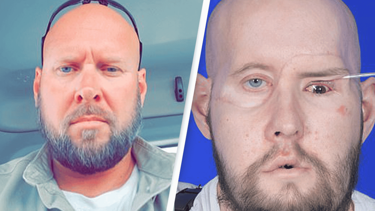 Man who lost half his face after being electrocuted receives first-ever ...
