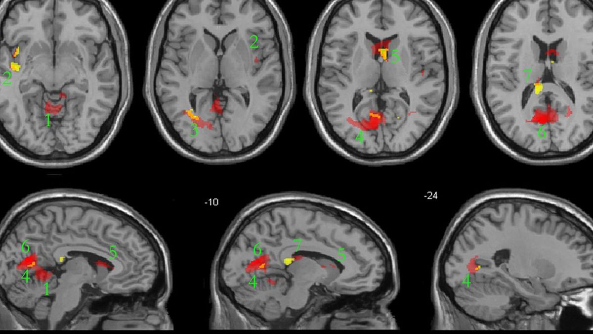 Shocking MRI scans show stark difference between brains of smokers vs ...