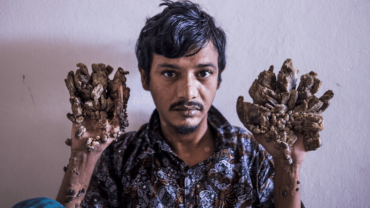 'Tree man' reveals 'unbearable pain' of living with rare disease with ...