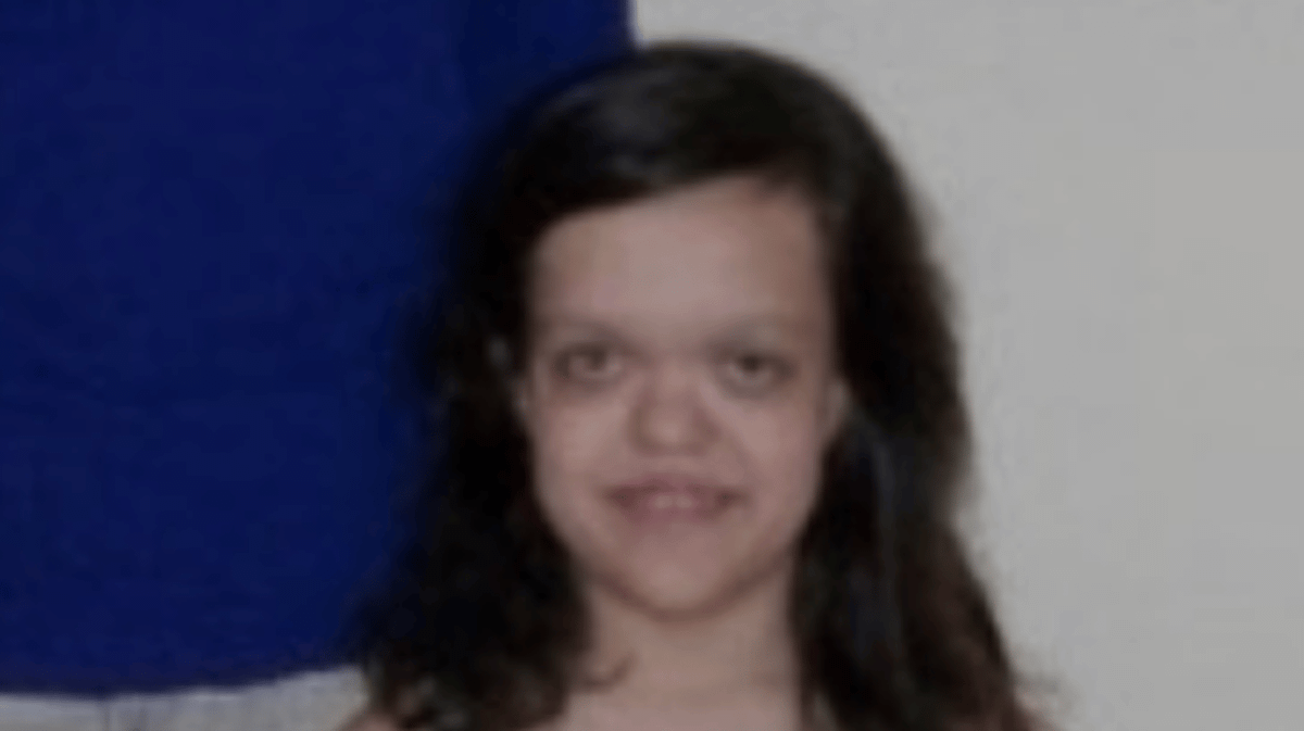 What teenager who underwent 'taboo' surgery to grow 13 inches looks ...