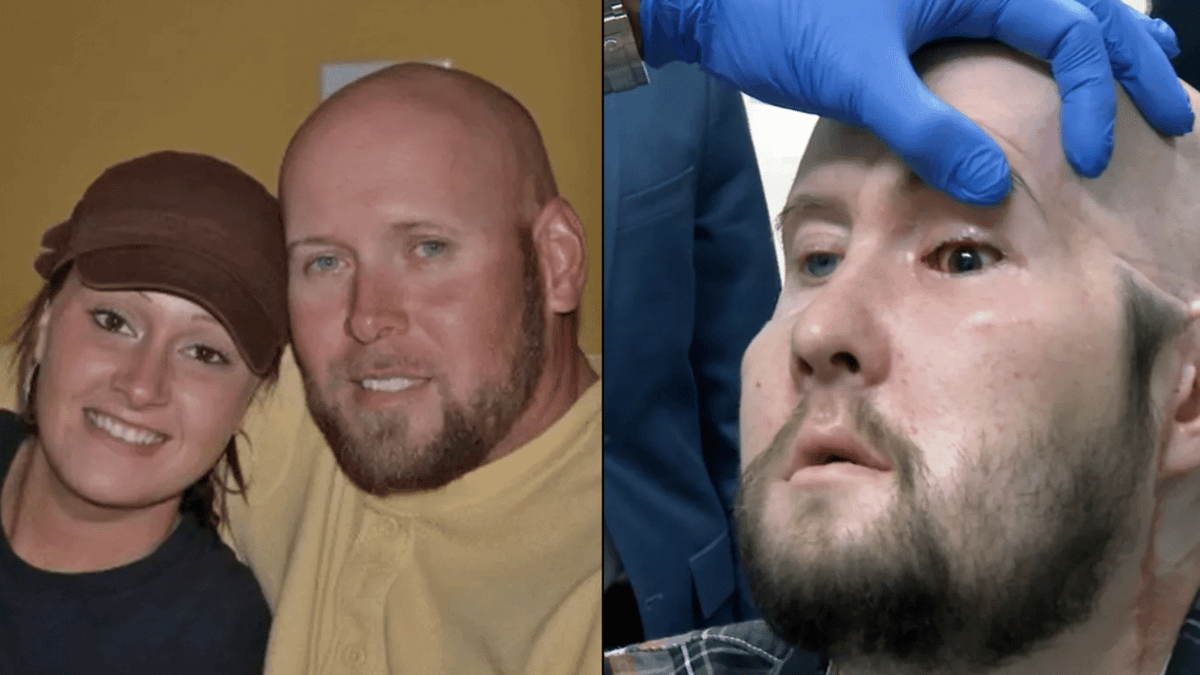 Man who had face electrocuted off at work gets world first eye and face ...
