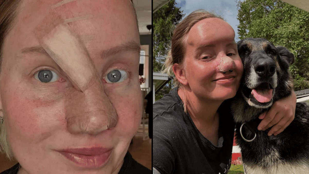 Woman who had nose bitten off by dog 'scared of firework' decides to ...